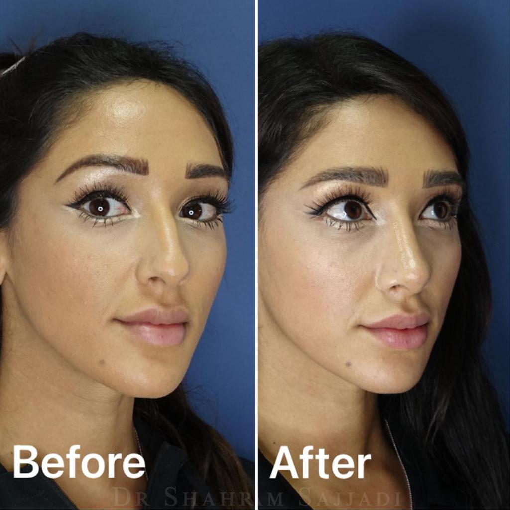 RHINOPLASTY: A SURGERY TO BEAUTIFY YOUR NOSE!